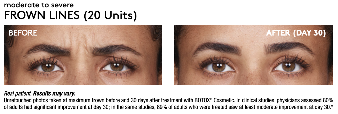 Botox Before and After 6 - Renew Wellness & Aesthetics