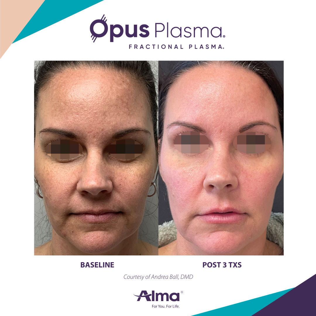 Opus Plasma® Laser Resurfacing in Oklahoma | Renew Wellness